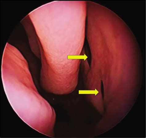 Ostium Of Maxillary Sinus Figures