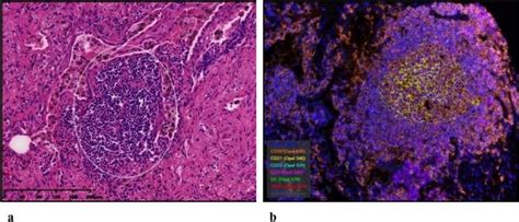 The Impact Of Tertiary Lymphoid Structures On Tumor Prognosis And The