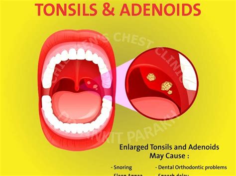 Common Side Effects Of Anti Tuberculosis Tb Medicines Dr Ankit Parakh Indias Best