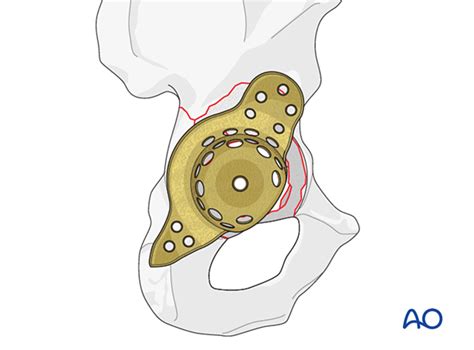 Revision Of Cup To Antiprotrusio Cage For Intraoperative Fracture During Acetabular Component