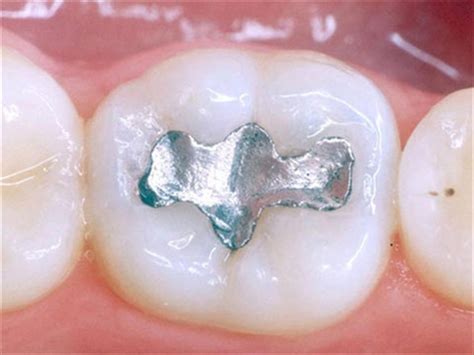 Rimuovere i metalli pesanti è sempre la scelta giusta Benessere Più