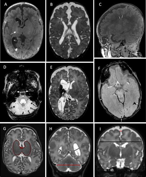 Acute Histologic Chorioamnionitis Independently And Directly Increases