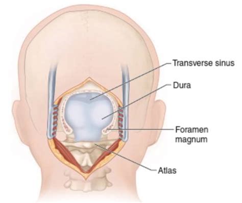 Suboccipitalcraniectomy Neurosurgery Education Wiki