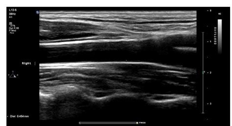 intima medial thickness imt measurement approximately 1 cm before the