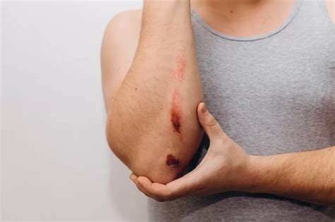 Mengenal Ulkus Dekubitus Atau Luka Baring Ini Penyebab Gejala Dan