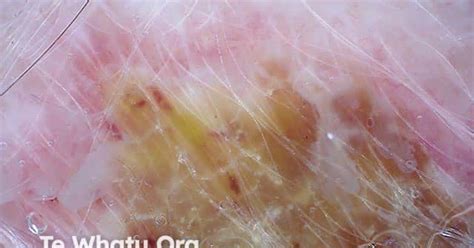 Erosive Pustular Dermatosis Of The Scalp Image