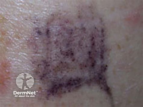 Patch Tests Image