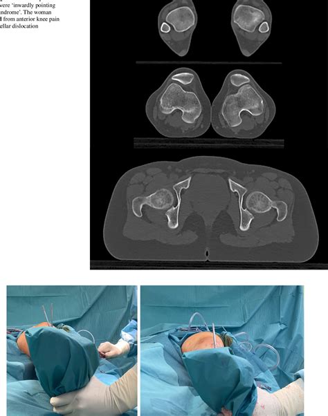 Figure 2 From Double Level Torsional Osteotomy A Treatment For The