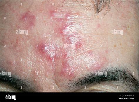 Acne Rosacea On The Skin Of The Forehead In A 57 Year Old Male Patient