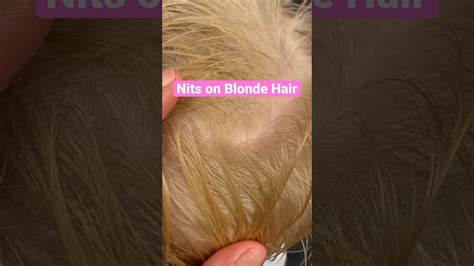Head Lice Eggs On Blonde Hair