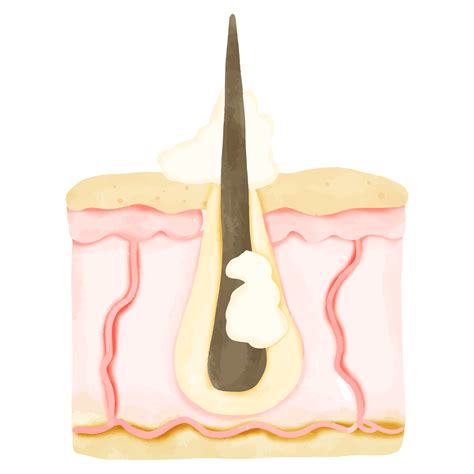 Watercolor Illustration Of Hair Follicle With Sebum Overproduction