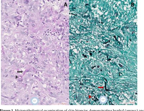 Figure 2 From Recurrent Subcutaneous Phaeohyphomycosis Due To