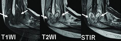 Magnetic Resonance Imaging Showed Joint Effusion Bone Marrow Oedema