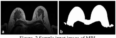 Figure 2 From Breast Cancer Classification Using Customized Resnet Based Convolution Neural