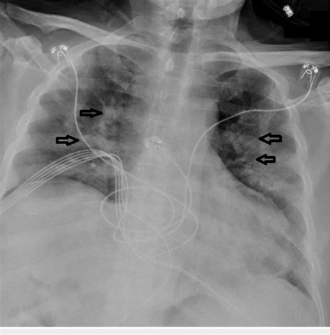 Portable X Ray Chest Ap View Showing Bilateral Pulmonary Infiltrates