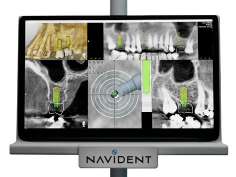Navident 4 EVO Next Generation Dynamic Navigation Recursos Médicos