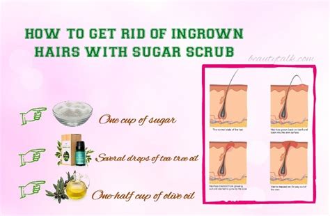 Top 24 Ways How To Get Rid Of Ingrown Hairs Fast And Naturally