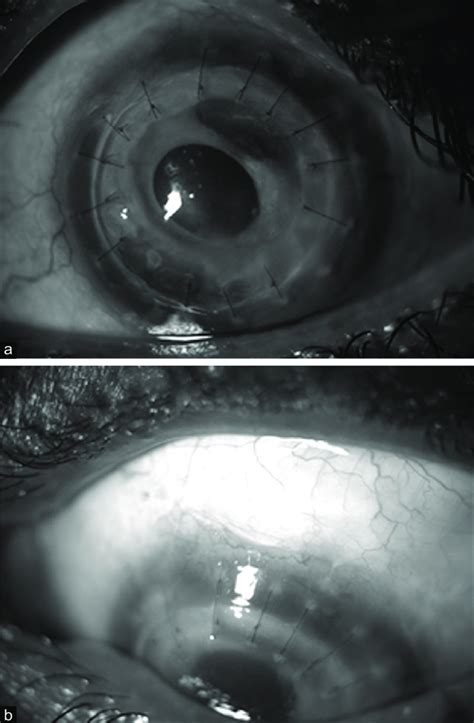 A Post Pk Patient With 360° Pas Developed Secondary Angle Closure