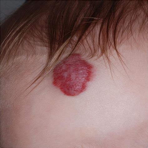 Clinical Photo Of An Infantile Hemangioma Of The Forehead In A