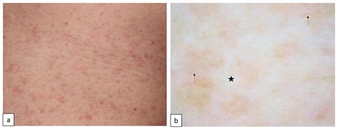 Dermoscopic Patterns Of Genodermatoses A Comprehensive Analysis