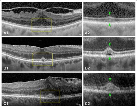 Tractional Abnormalities Of The Central Bouquet A1 C1 The