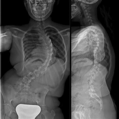Ap And Ll Postoperative X Rays Download Scientific Diagram