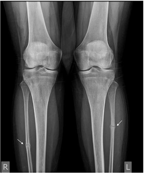 Fractured Fibula X Ray