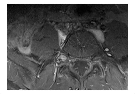 Magnetic Resonance Imaging Lumbar Spine With Contrast Showing Nerve