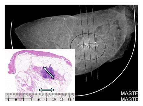 Mastectomy Specimen Large Format Histopathology Correlation Unifocal