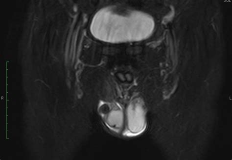 Extratesticular Scrotal Epidermoid Cyst Pacs