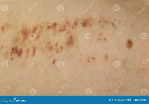 Bruising And Scratches On The Skin Texture Background Royalty Free Stock Photo CartoonDealer