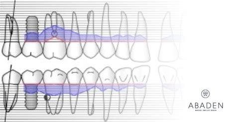 ¿qué Es Y Cómo Se Hace El Sondaje Periodontal Abaden