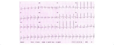 Electrocardiogram With Pacemaker Bicameral Estimulation Dddr Mode Download Scientific