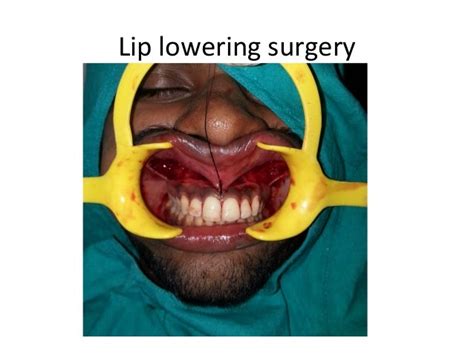 Lip Repositioning Surgery For Gummy Smile Correction