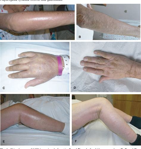 Nephrogenic Systemic Fibrosis