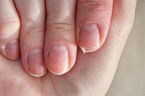 Eggshell Nails Hapalonychia Symptoms And Treatment