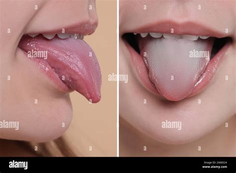 Woman Showing Her Tongue Before And After Cleaning Procedure Closeup Tongue Coated With Plaque