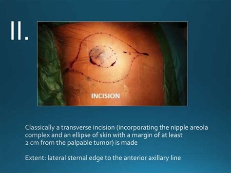 Modified Radical Mastectomy