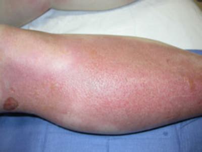 Thermal Burn Management Of Burns