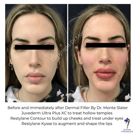 Juvederm Fillers At Slater Aesthetics Atlanta And Warner Robins