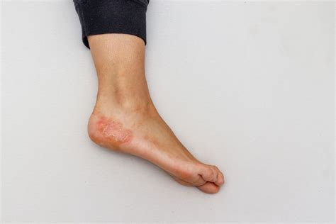 Common Foot Rashes Symptoms Causes And Treatments