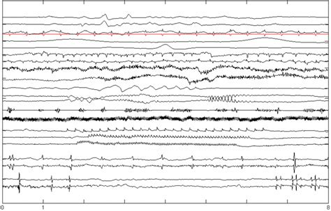 Common Eeg Artifacts Found In The Eeg Database Photic Stimuli Should