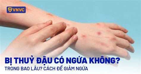 Bị Thuỷ đậu Có Ngứa Không Trong Bao Lâu Cách để Giảm Ngứa
