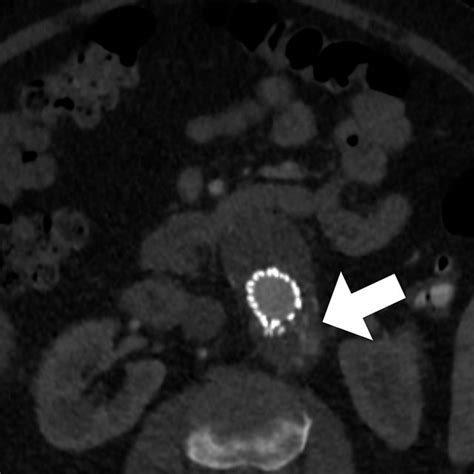 Dual Source Dect Angiography Of A 68 Year Old Male Patient One Month