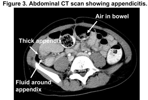 Appendicitis Ct 소견 네이버 블로그