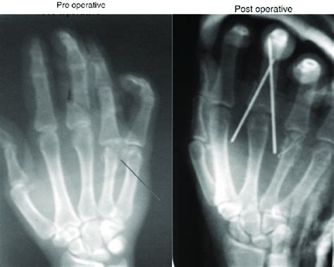 Open Two Part Fracture Of The 4th Metacarpal Head And Fracture Proximal