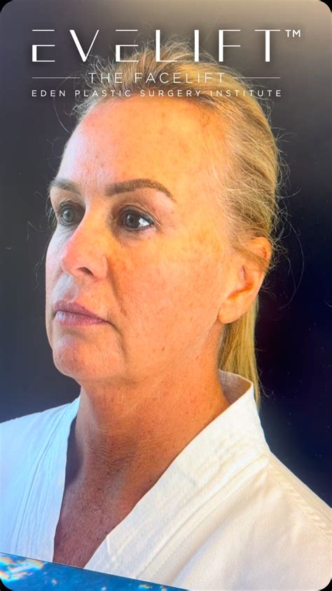 Evelift® Eveliftofficial • Instagram Photos And Videos
