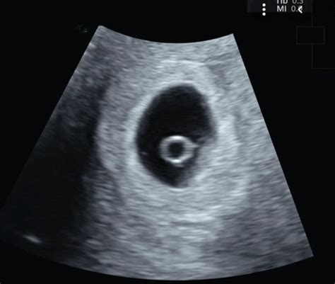 Placenta Cervix Cord Images Flashcards Quizlet