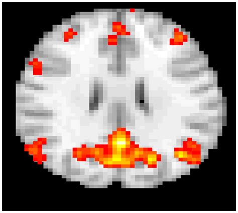 The Default Brain Network Obtained Via Fastica And Overlaid On A