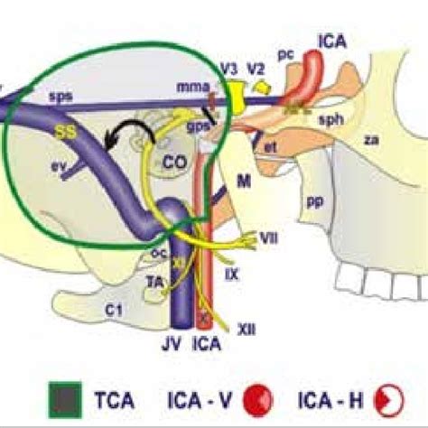34 Schematic Drawing Showing The Modified Transcochlear Approach Type Download Scientific